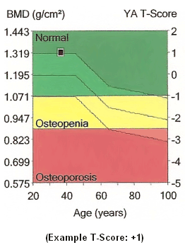 Osteoporosis Screening